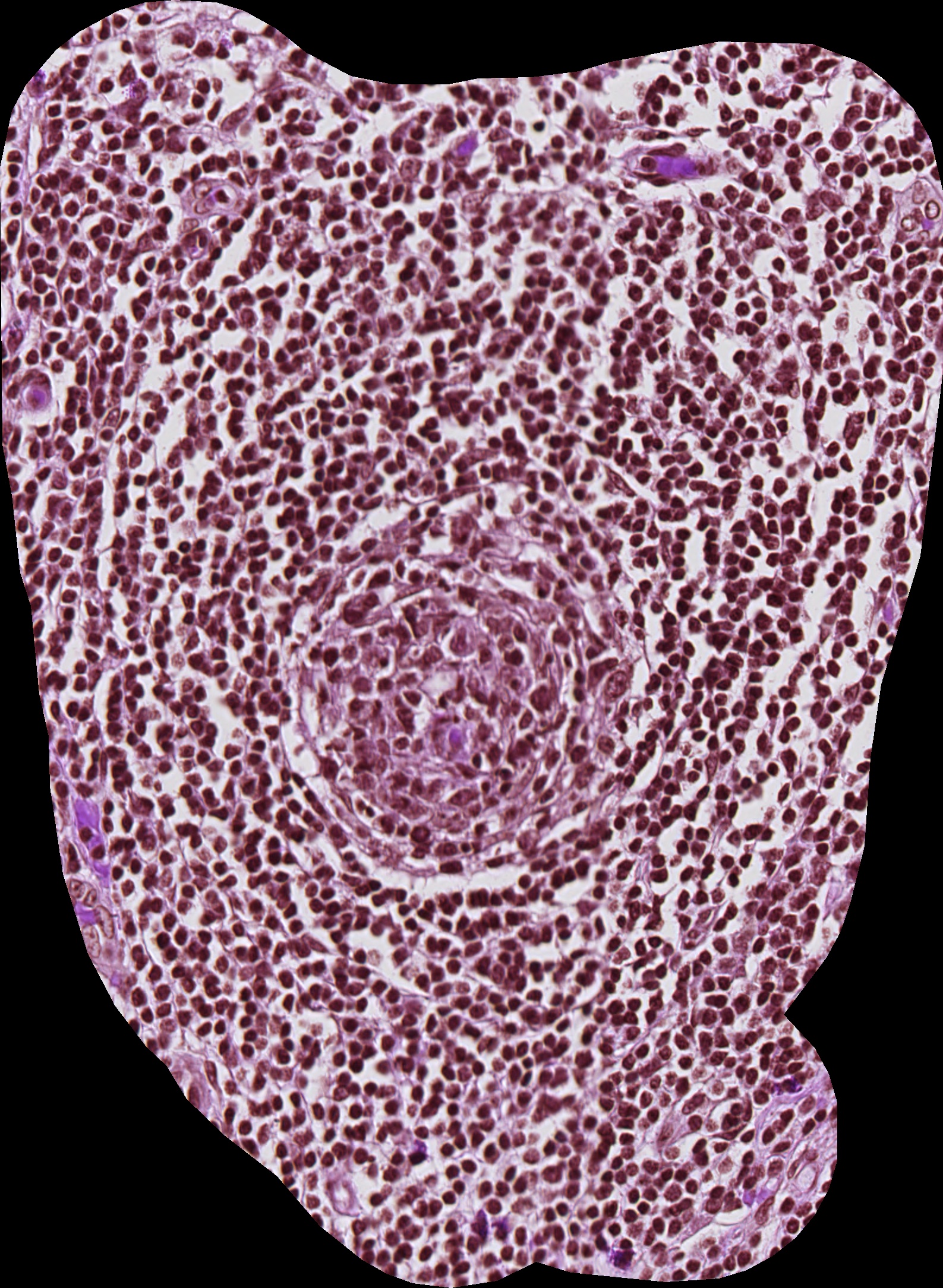 TCGA_BLCA_second Classification Dataset by Myown