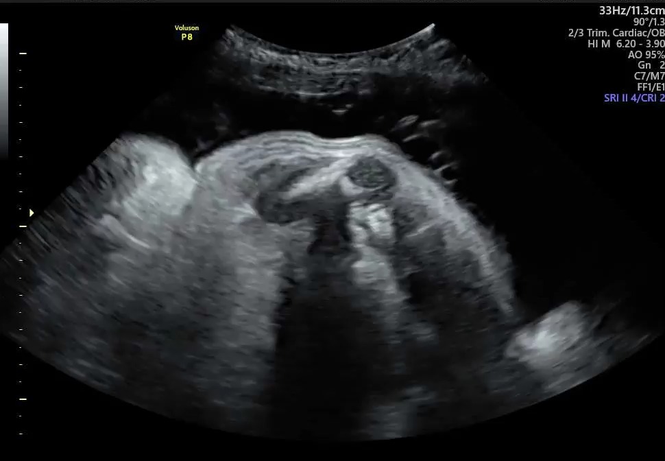 Ct Scan Instance Segmentation Dataset By Person