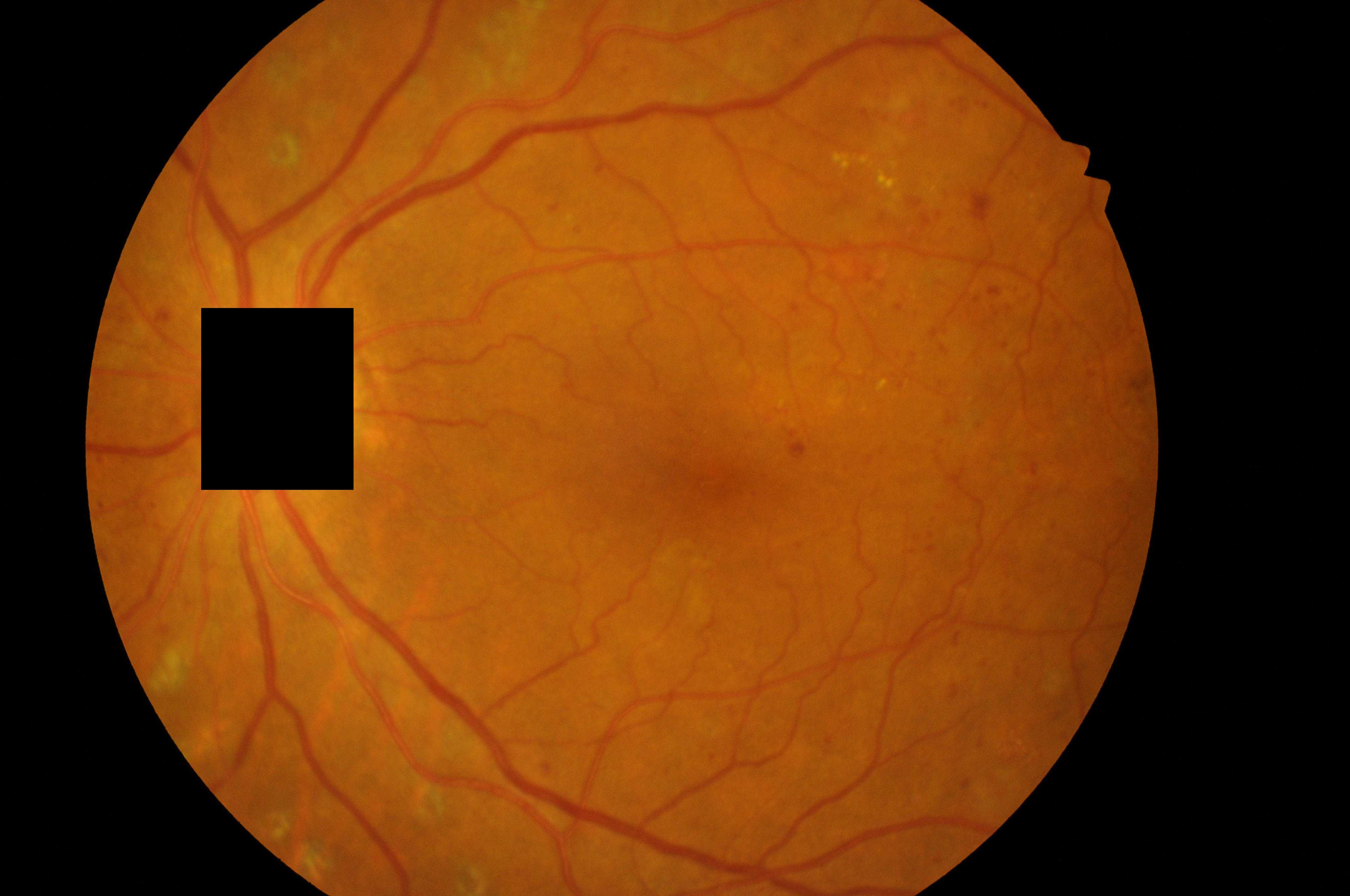 Class Hard Exudate Detection Roboflow Universe Search