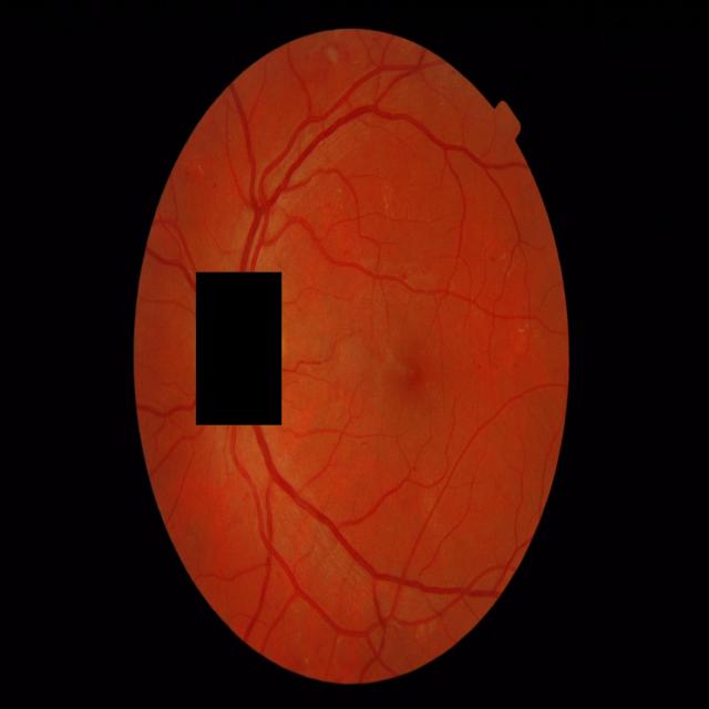 Macula New Object Detection Dataset By Zahraa