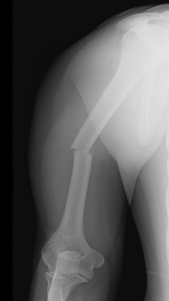 bone fracture Object Detection Dataset and Pre-Trained Model by ws1