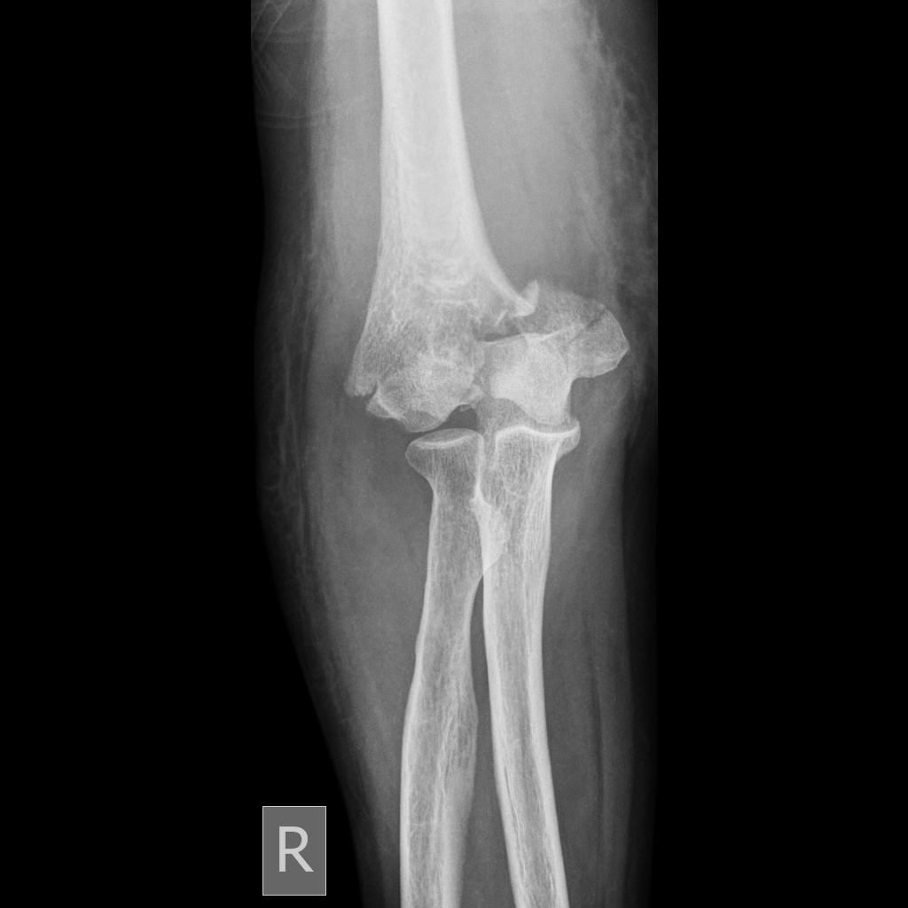 bone_fracture Object Detection Dataset by dataaugmentation