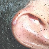 leprosy - Roboflow Universe