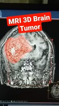 brain tumor Object Detection Dataset by cv