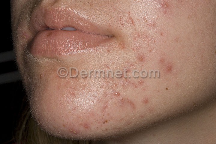 Skin (skin-appep) - Roboflow Universe