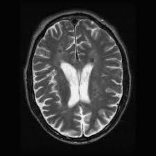 BRAIN TUMOR Object Detection Dataset by LIKHITHWORKSPACE