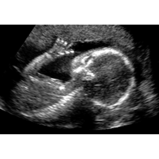 Fetus Detection Object Detection Dataset By Fetal Biometrics