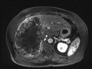 Liver Lesion MRI Object Detection Dataset by RVB
