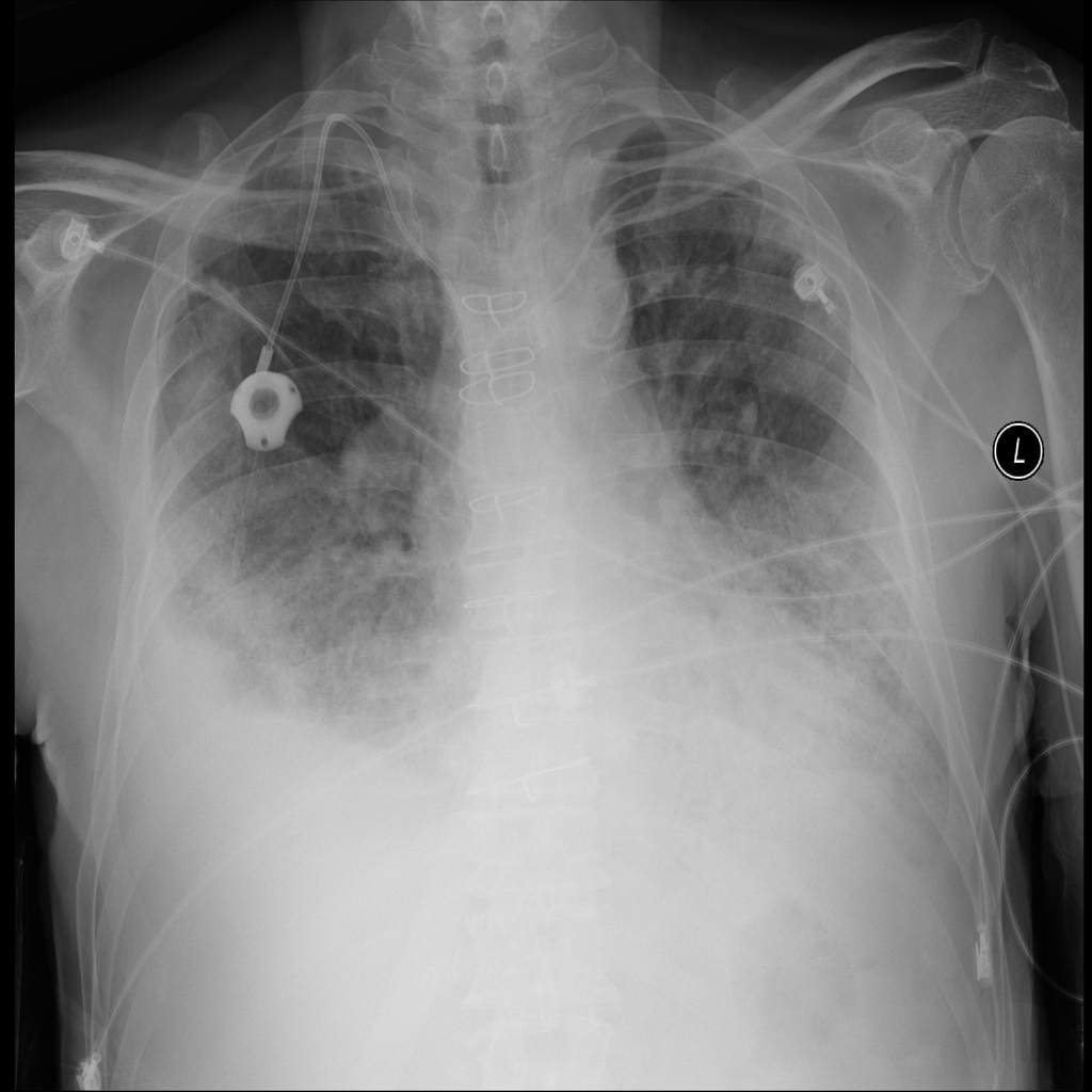 Pneumonia Chest X Ray Object Detection Dataset By Pleural Effusion Chest Xray 