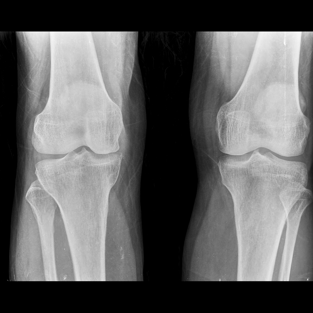 Knee Osteoporosis Classification Dataset by tumor