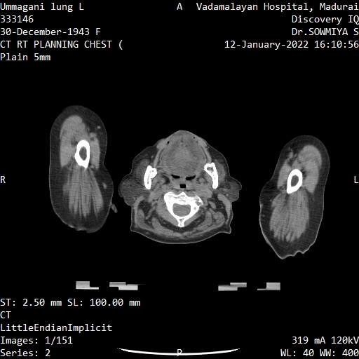 lung cancer Object Detection Model by Ragul Pauly