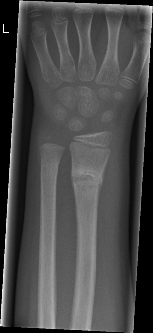 Fracturex Wrist Dataset Object Detection Dataset And Pre Trained Model