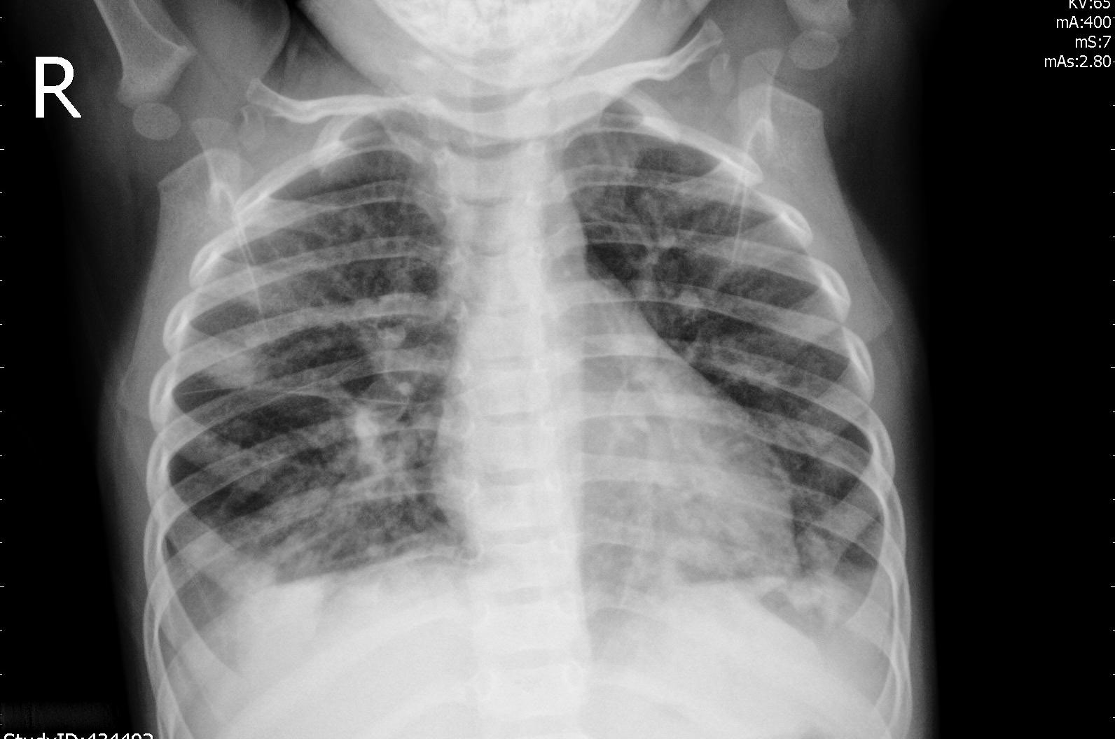 Pneumonia Detection Object Detection Dataset And Pre Trained Model By