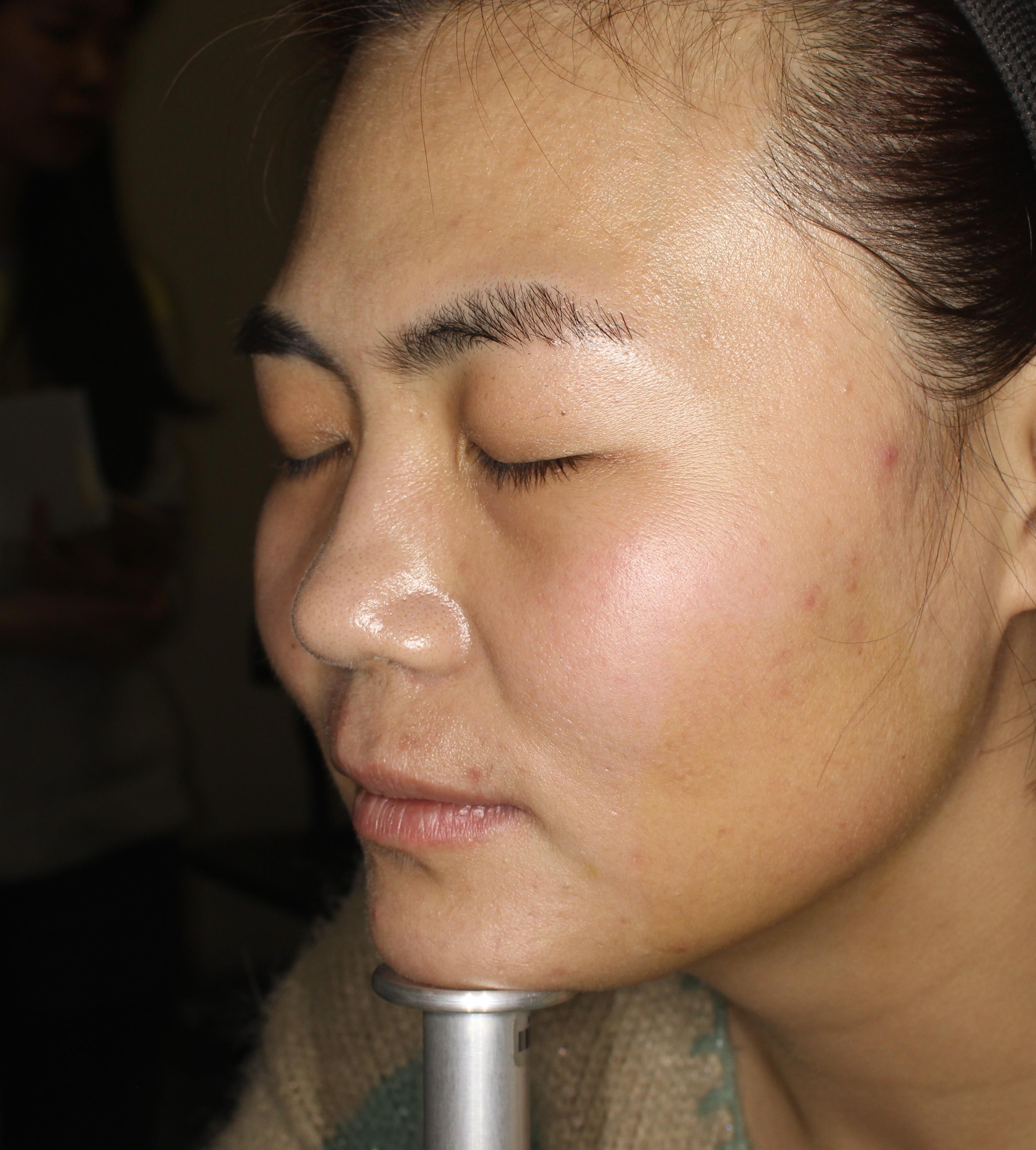 Acne Detection Final Object Detection Dataset And Pre Trained Model By Temjai