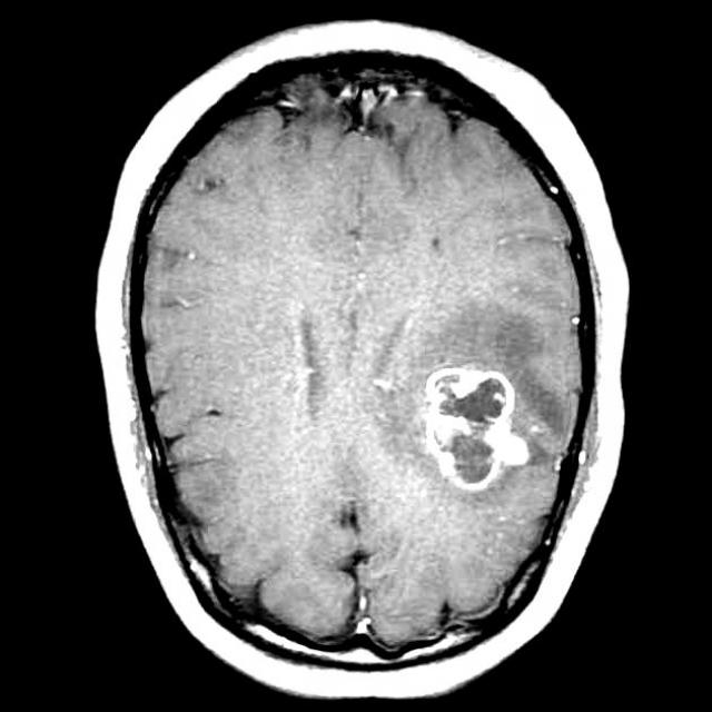 Brain Tumour Detection Object Detection Dataset And Pre Trained Model