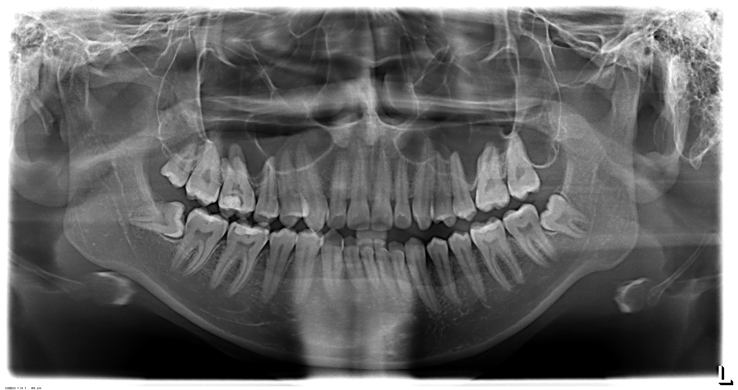 opg Instance Segmentation Model by car