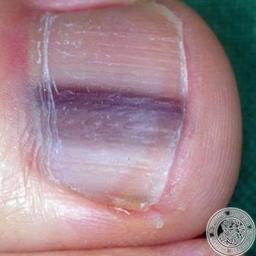 melanoma_nail Object Detection Dataset by NAILPROJECT