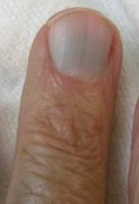 Bluish_Nail Object Detection Dataset by NAILPROJECT