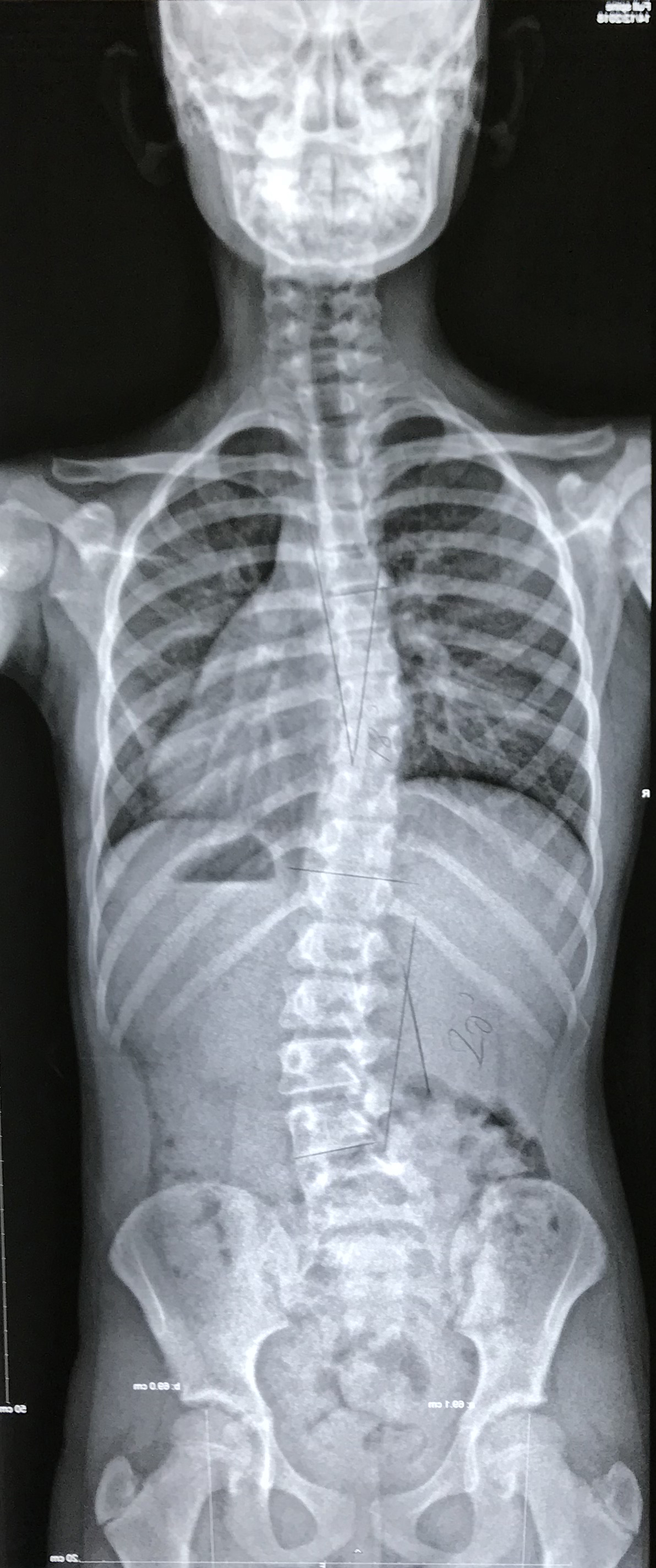 spine_det Object Detection Dataset by test42