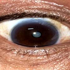 CATARACT_DETECTION Classification Model by Cataract