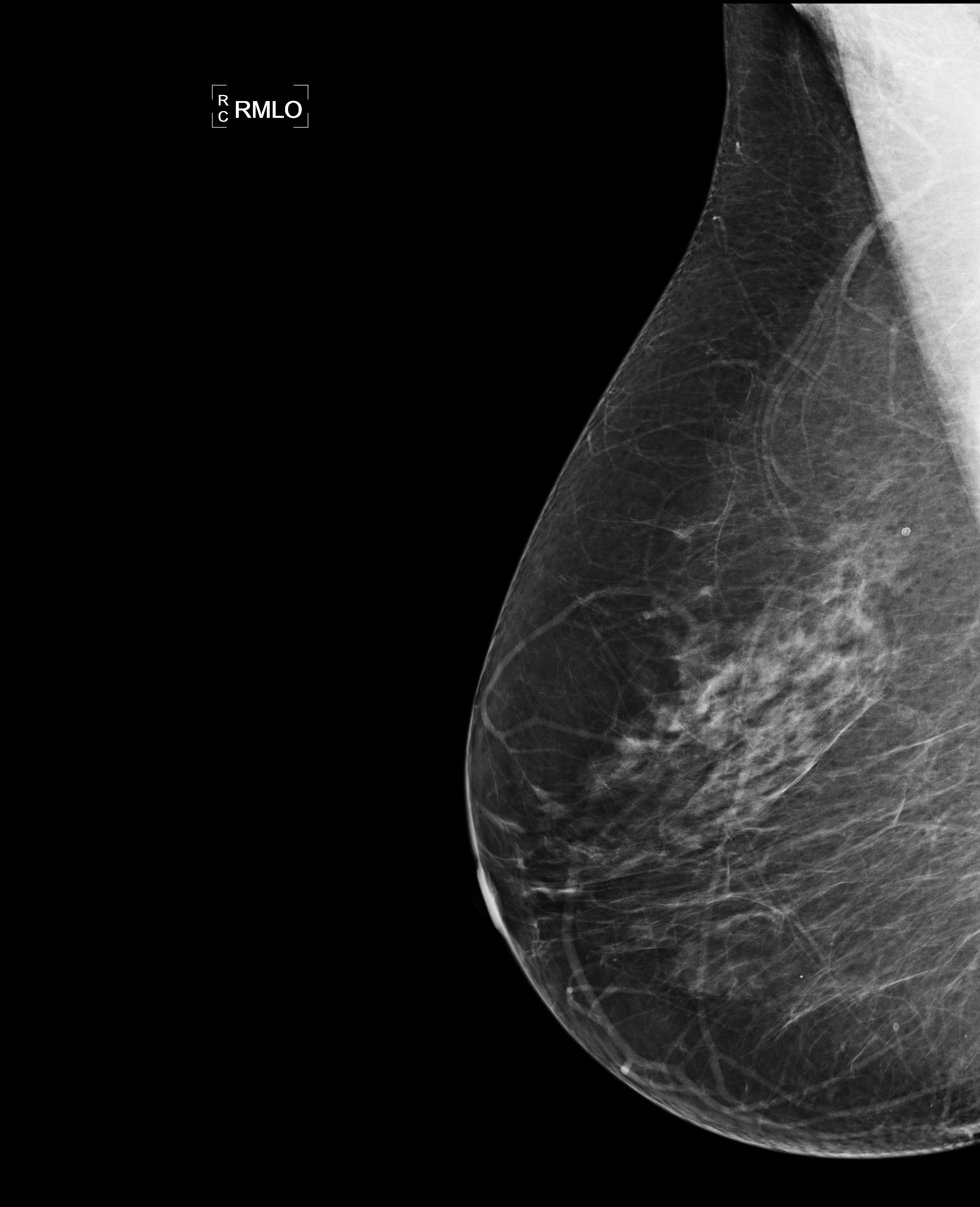 mammogram-findings Object Detection Dataset by caio workspace