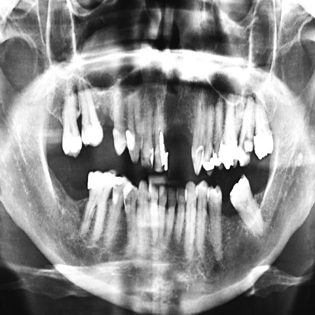 teeth Instance Segmentation Dataset (v2, 2025-05-01 5:18pm) by teethSegmentation