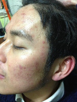 acne-detection-original Object Detection Dataset by skinlesions