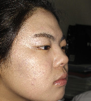 acne-detection-original Object Detection Dataset by skinlesions