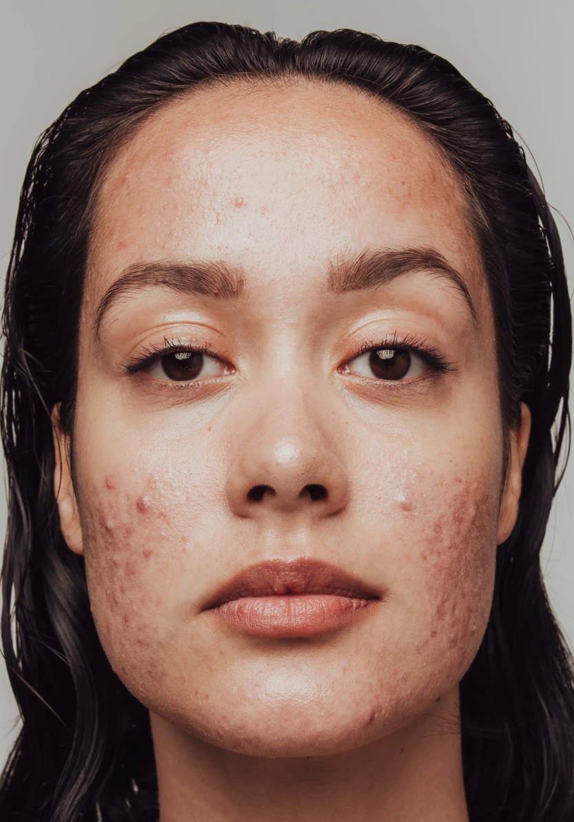 skin-type-clf Classification Dataset and Pre-Trained Model by skinlesions