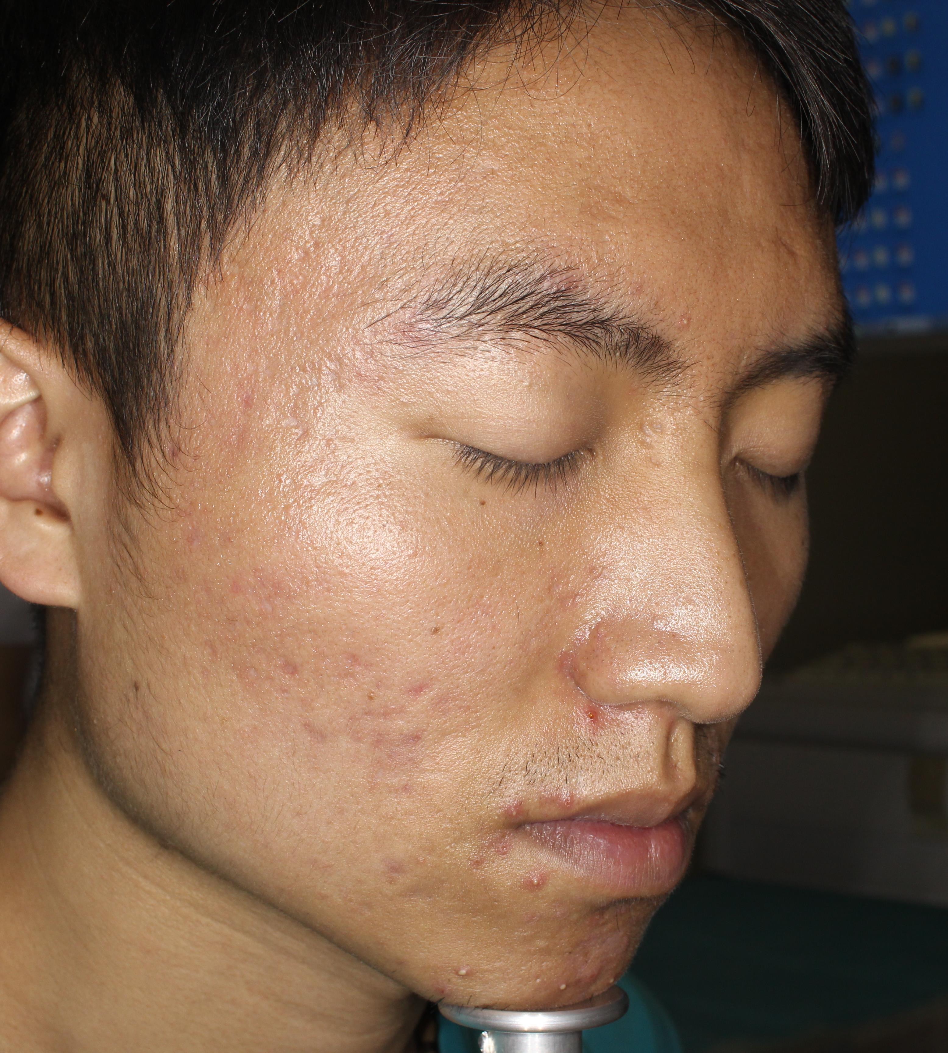 acne-detection-original Object Detection Dataset by skinlesions