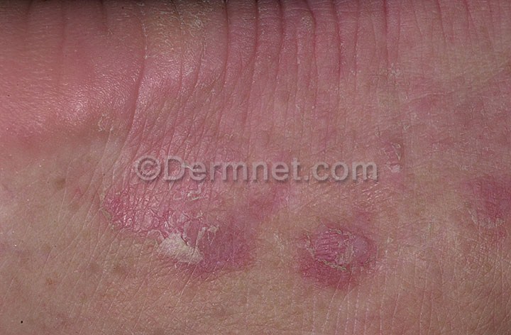 Tinea Classification Model by Eczema