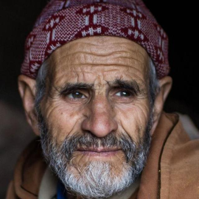 Melasma Classification Model by Eczema