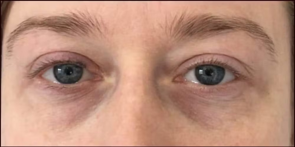 Dark Circles Object Detection Dataset by Bluesense