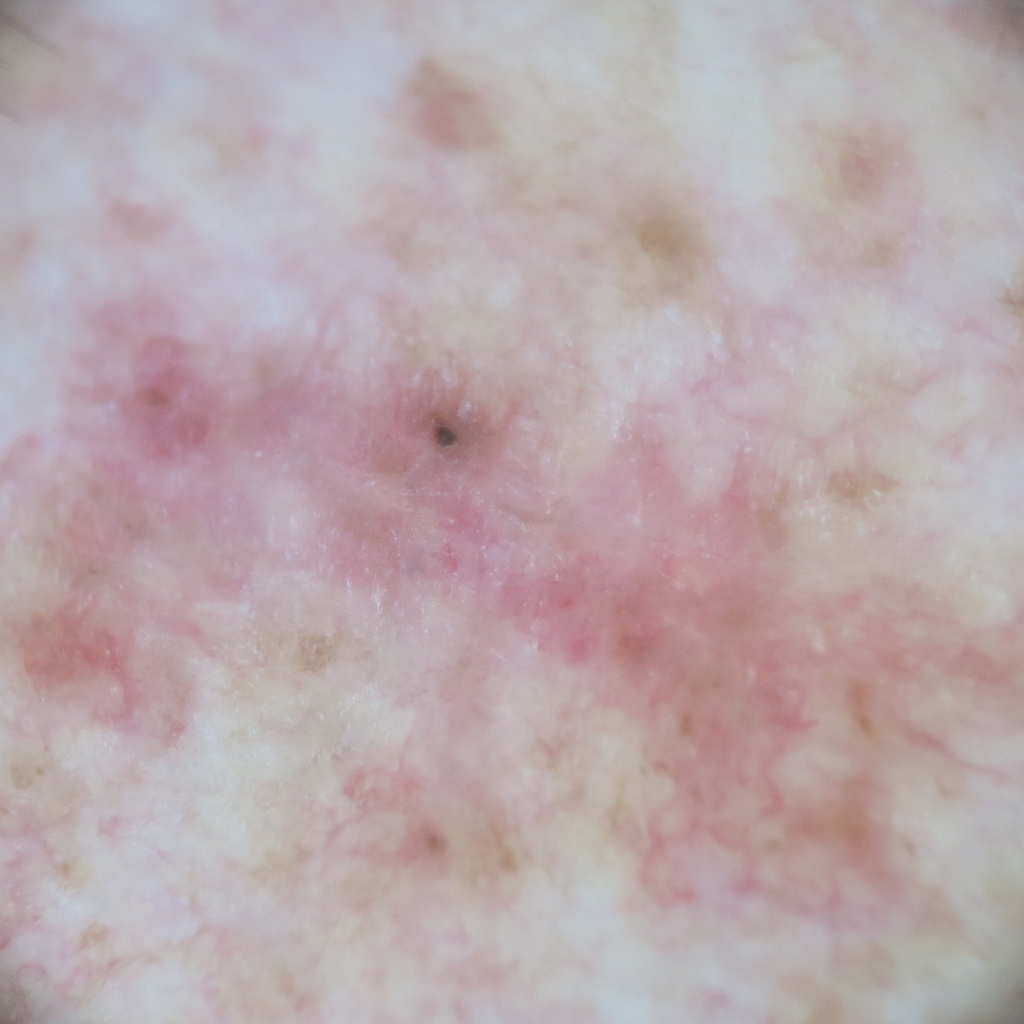 Skin Cancer Object Detection Dataset by AIDA