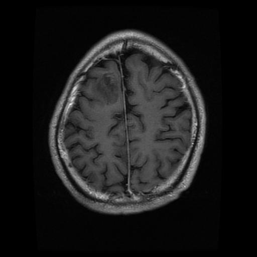 How to Use the Brain Tumor Object Detection API