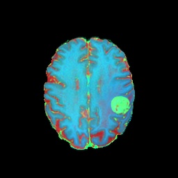 brats_2023 Instance Segmentation Dataset by bRATs1