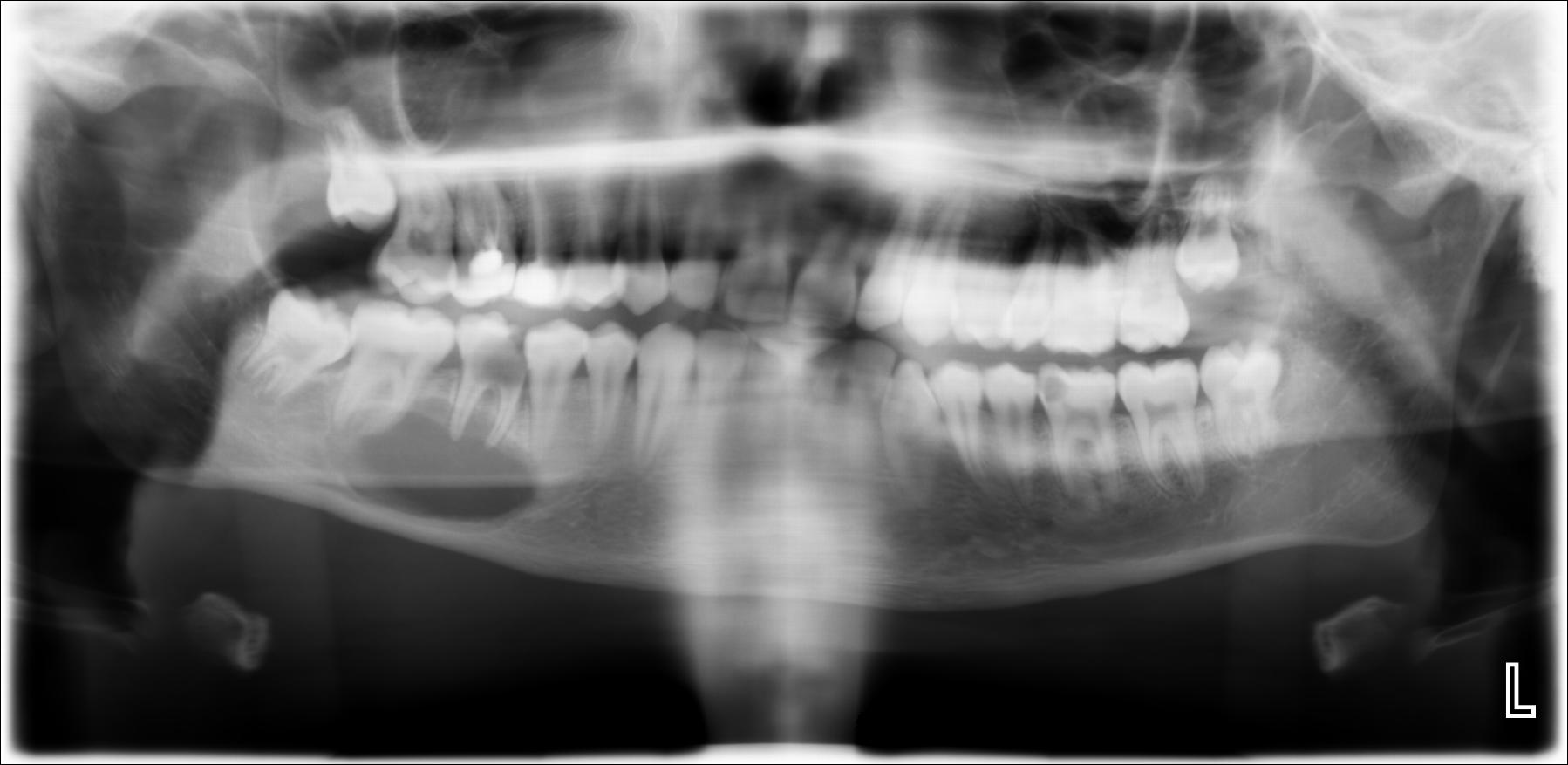 Jaw Cysts Demo Object Detection Dataset and Pre-Trained Model by Cyst Detection