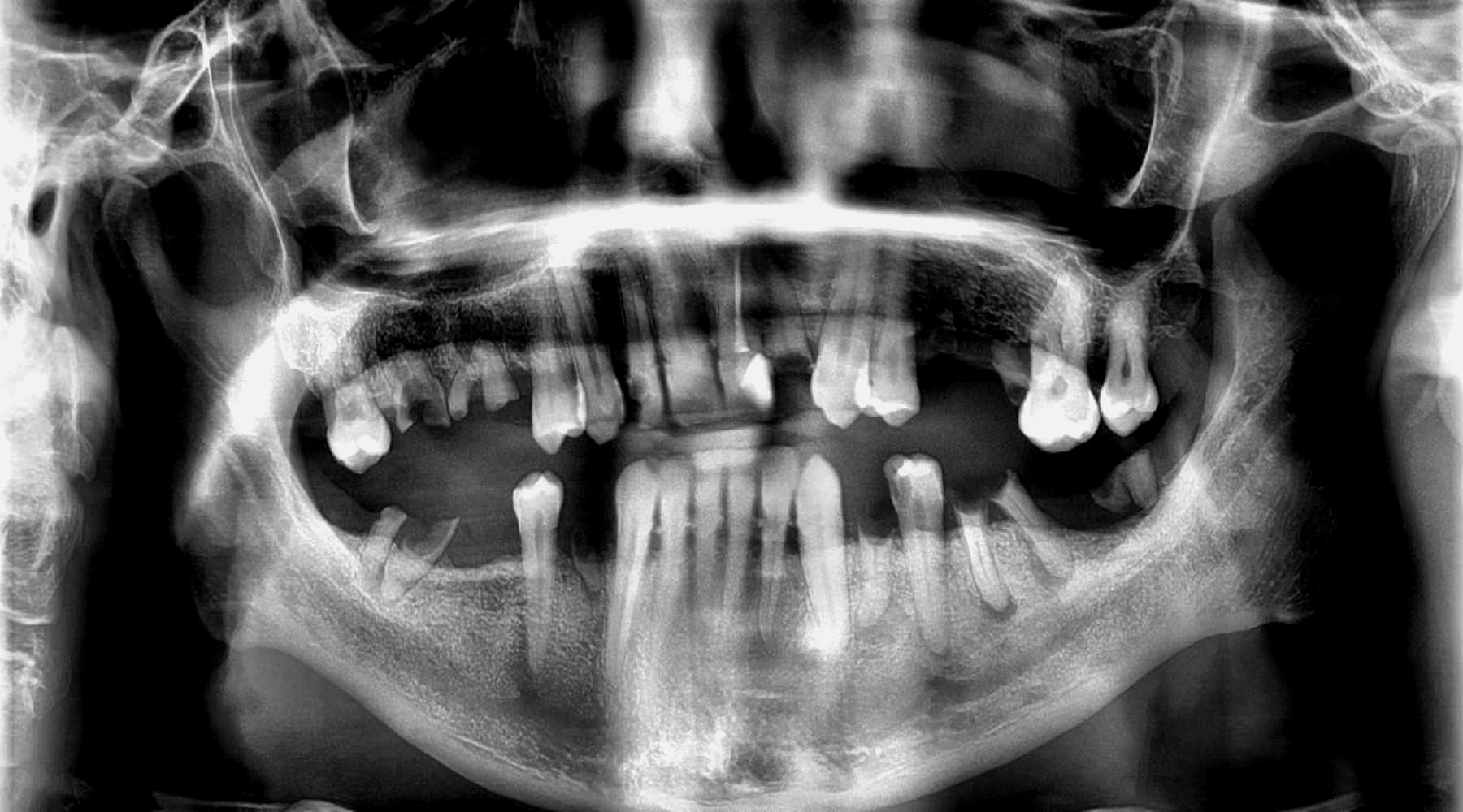 Caries Instance Segmentation Dataset By Caries