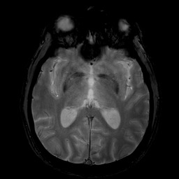 Alzheimer Object Detection Dataset and Pre-Trained Model by DEFISIENSI ...