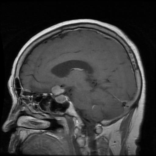 Brain Tumor Detection Object Detection Dataset By Machine Learning Assignments