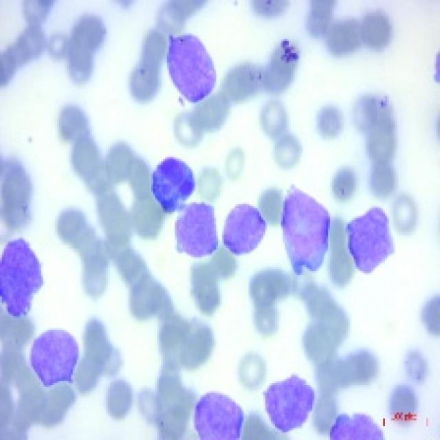 leukemia Classification Model by project