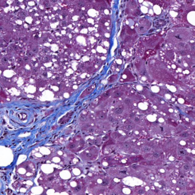 Liver disease prediction Classification Model by final year IT