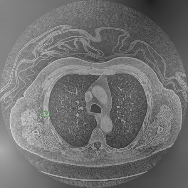 Lung Cancer Object Detection Dataset And Pre Trained Model By Futball