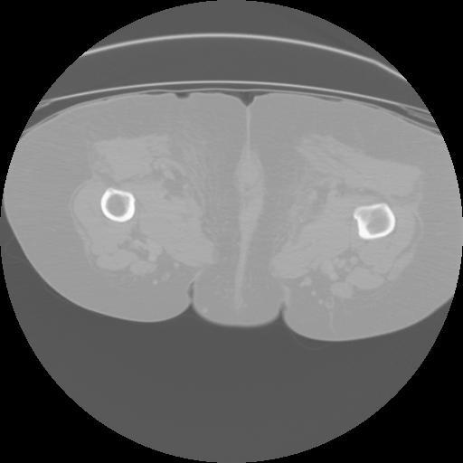 Liver Tumor Detection Object Detection Dataset And Pre Trained Model By