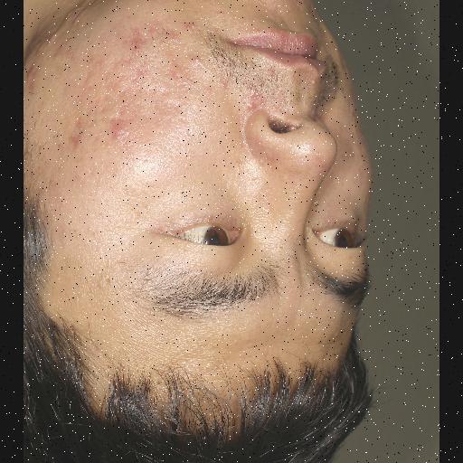 Acne Detection Object Detection Dataset And Pre Trained Model By Pranjal