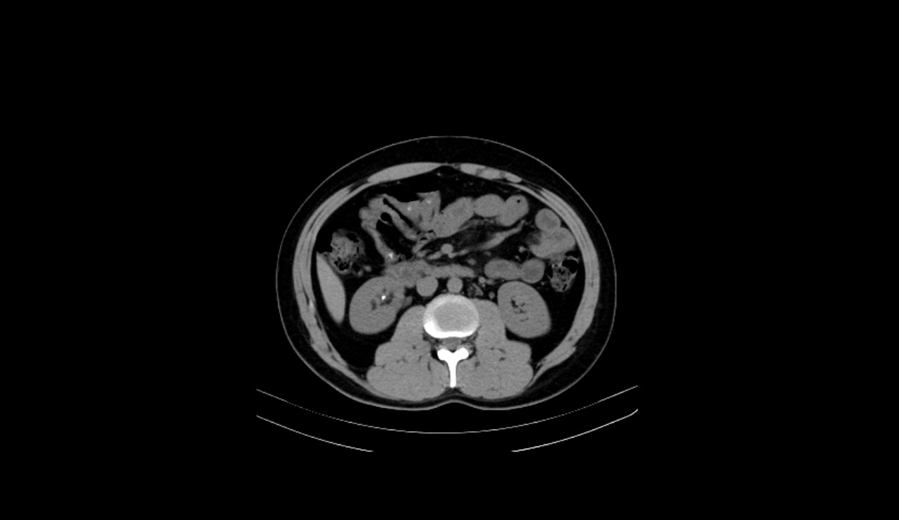 Axial CT Imaging Kidney Stone Classification Dataset by xray