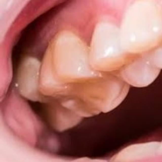 Dental Caries Classification Model By Dentalcariesv2