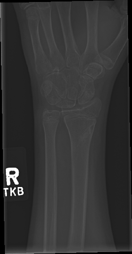 Fracture Wrist Computer Vision Dataset By Fracture Detection And Classification