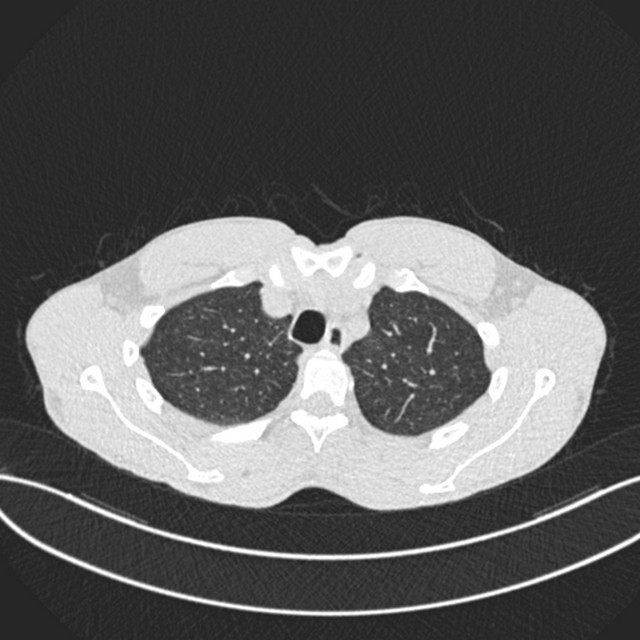 Classification Brain Tumor Roboflow Universe