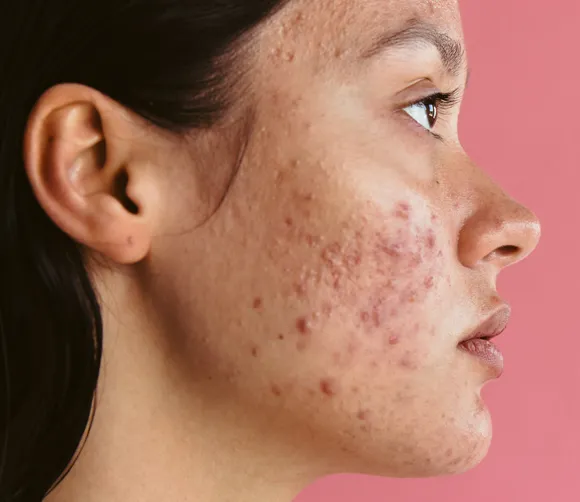 skin-analysis Instance Segmentation Dataset by ulyatsaniya